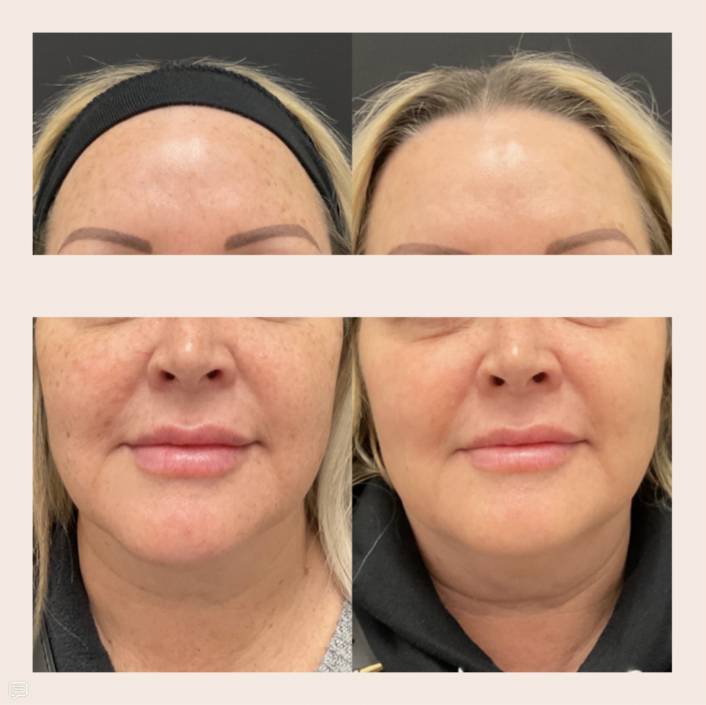 Expert Botox Lemon IL: Beauty & Skin Care Treatment